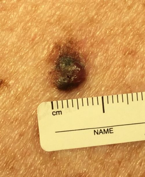 Malignant Melanoma - Clear Dermatology
